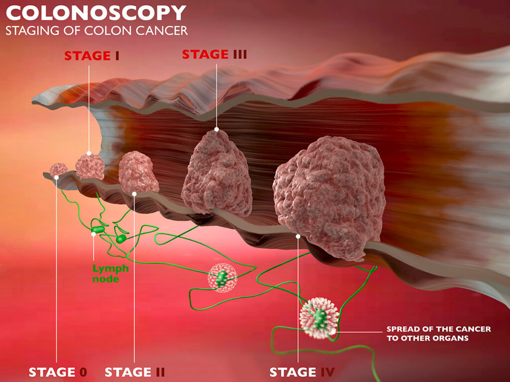 Colorectal Cancer: The Truth About Identification and Prevention ...